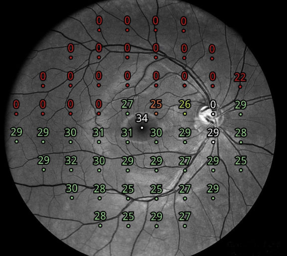 iCare COMPASS’ active retinal tracker compensates for eye movements in ...
